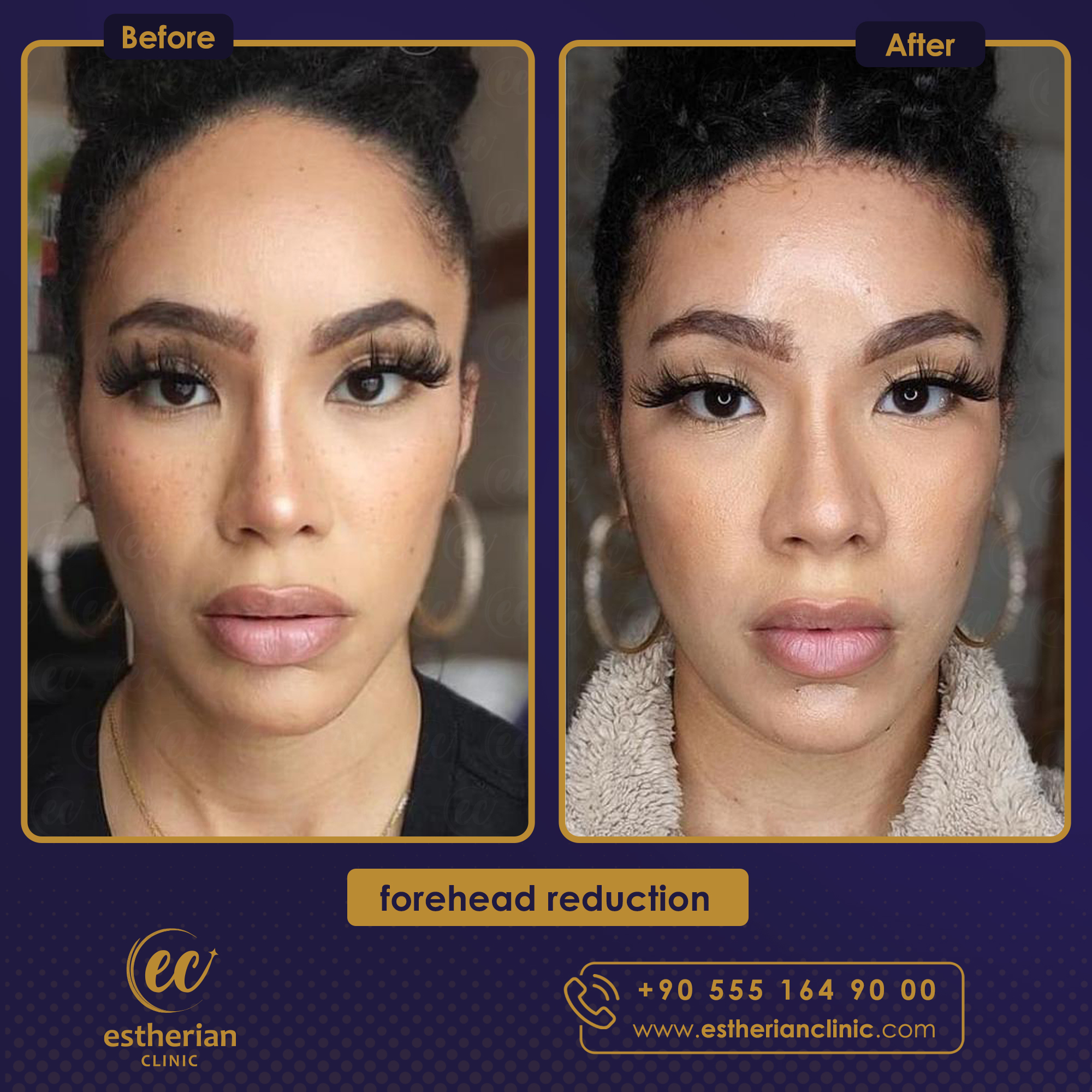 Hairline Lowering In Turkey - Estherian Clinic