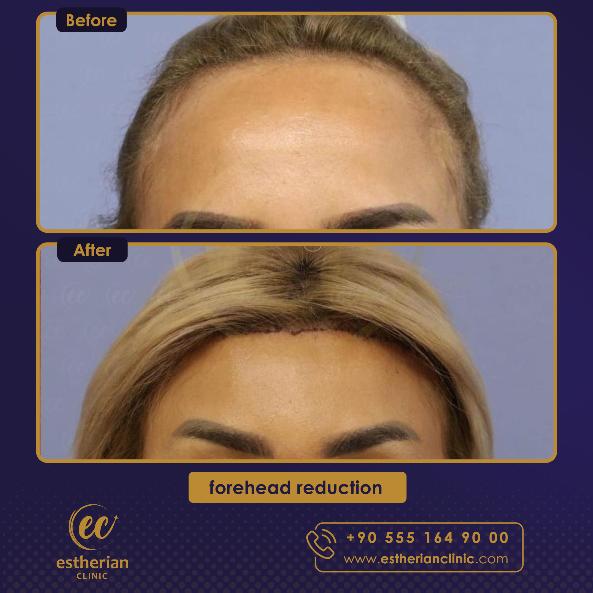 Hairline Lowering In Turkey - Estherian Clinic