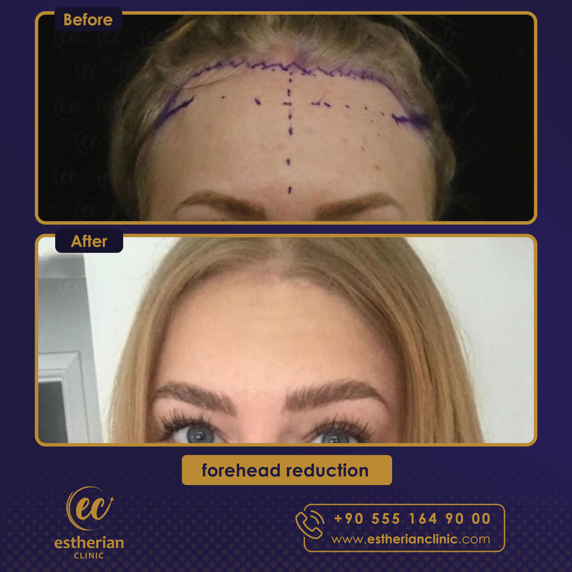 Hairline Lowering In Turkey - Estherian Clinic