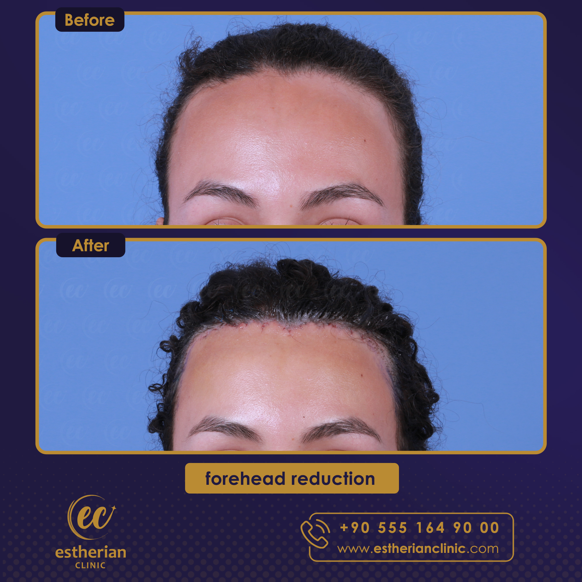 Hairline Lowering In Turkey - Estherian Clinic