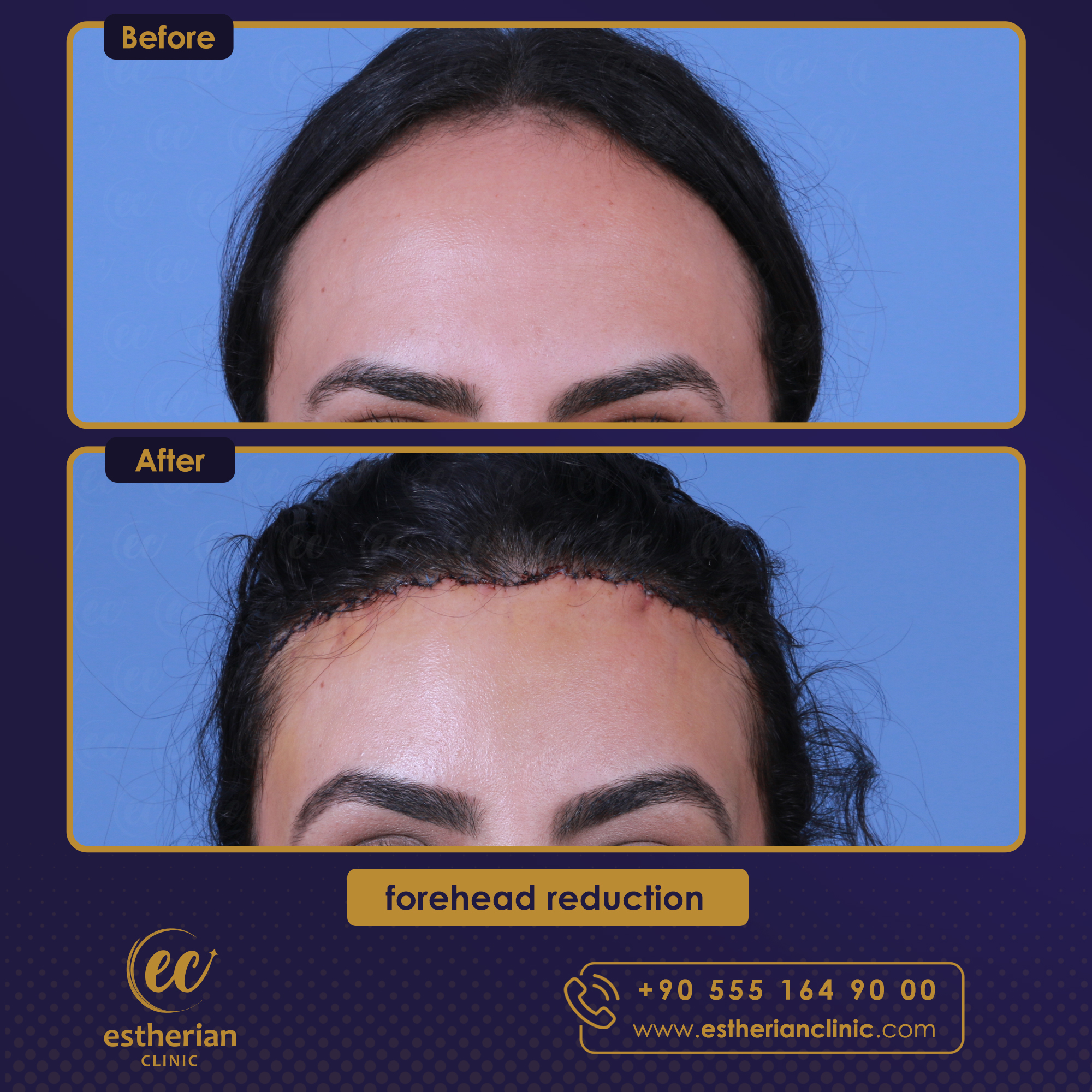 Hairline Lowering In Turkey - Estherian Clinic