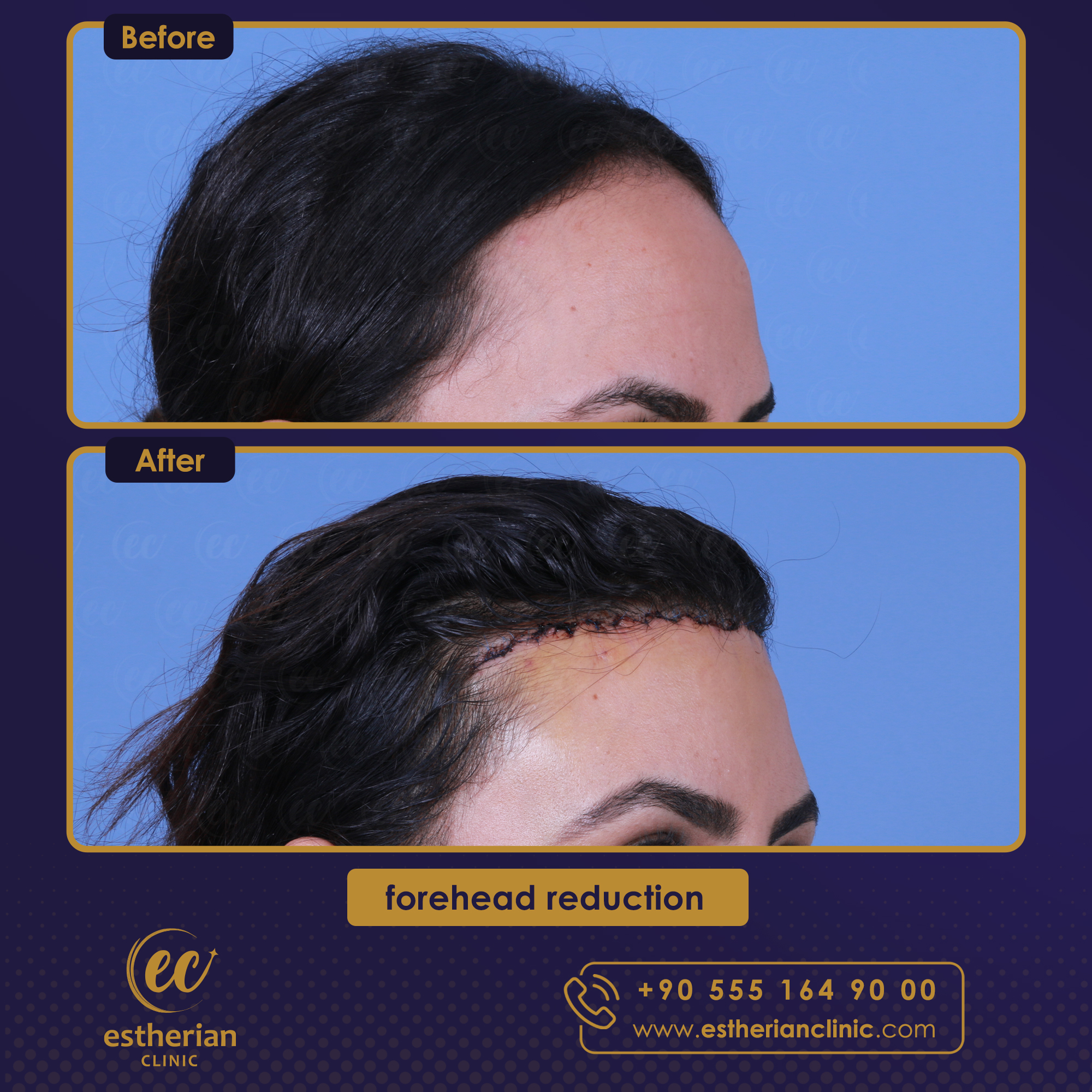 Hairline Lowering In Turkey - Estherian Clinic