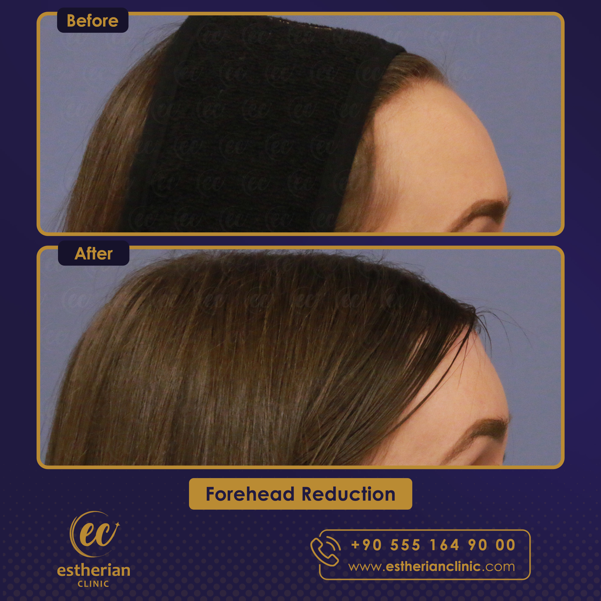 Hairline Lowering In Turkey - Estherian Clinic