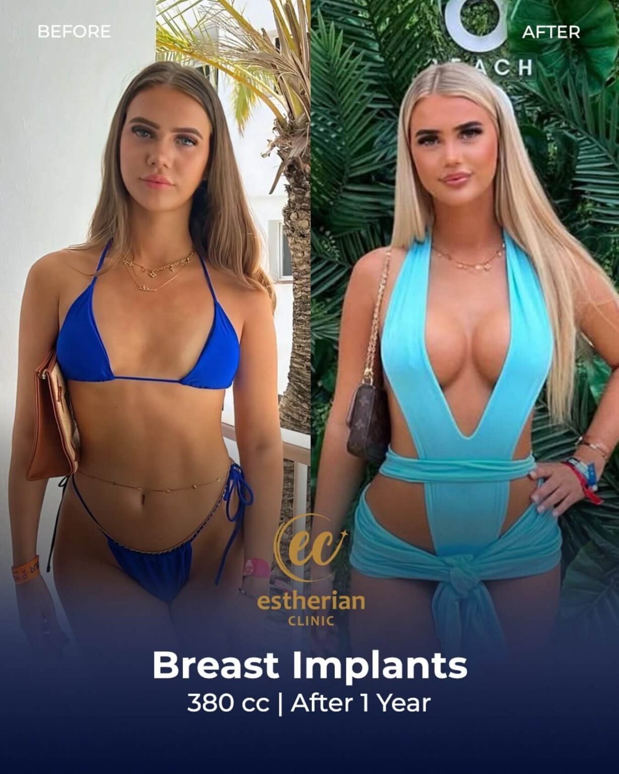 300 cc Breast Implant - Before and After | Estherian Clinic