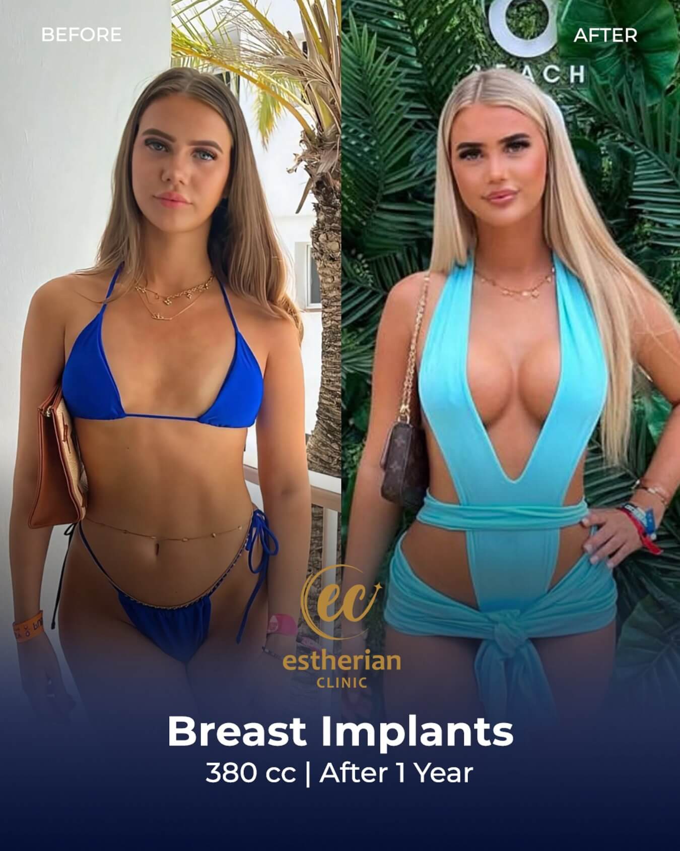 300 Cc Breast Implant Before And After Estherian Clinic