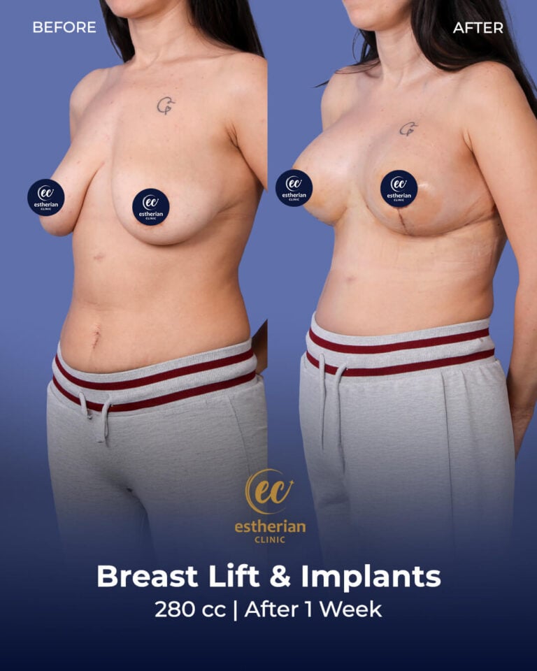 300 cc Breast Implant - Before and After | Estherian Clinic