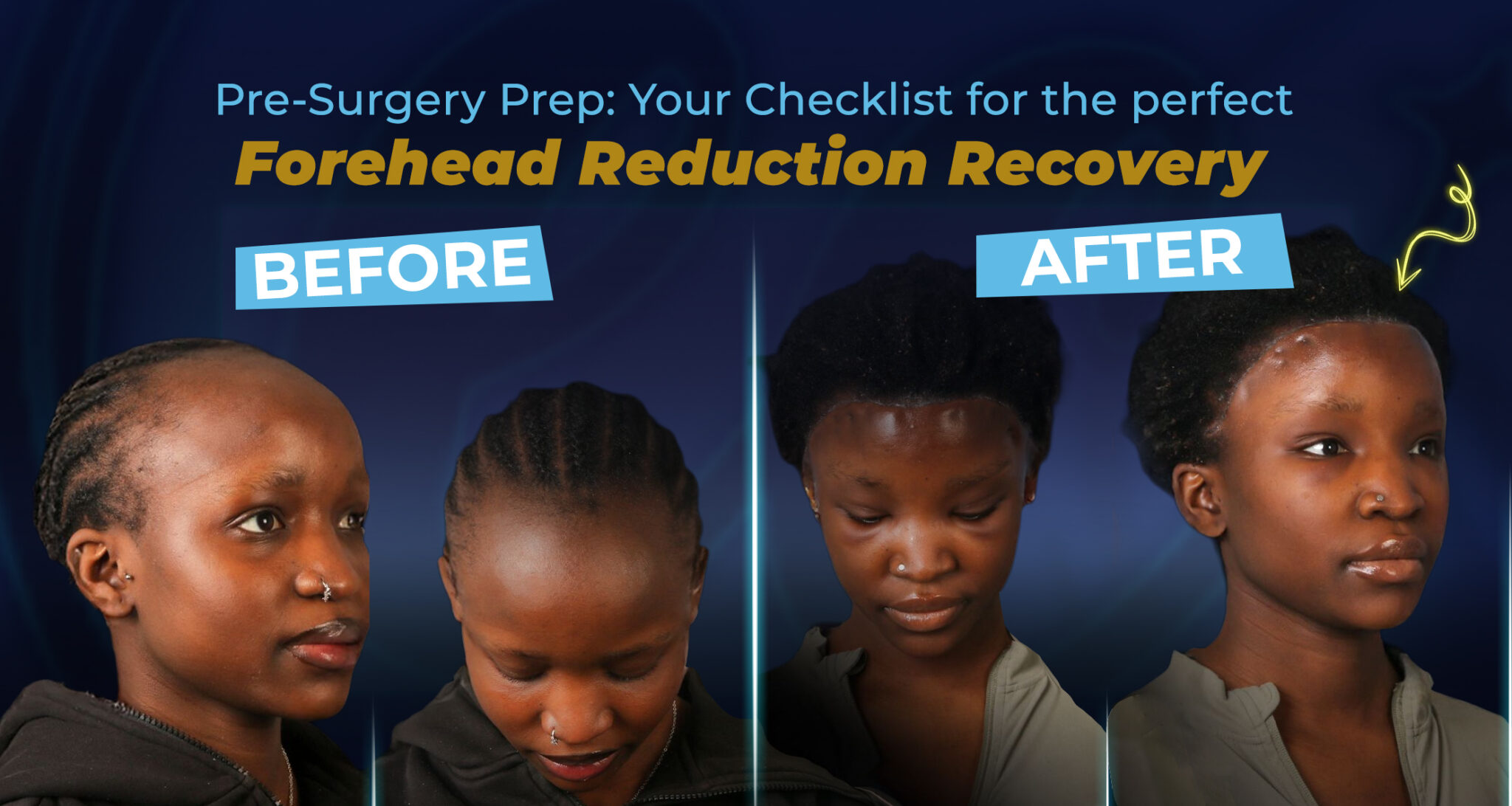 Pre-Surgery Prep: Your Checklist for the Perfect Forehead Reduction ...