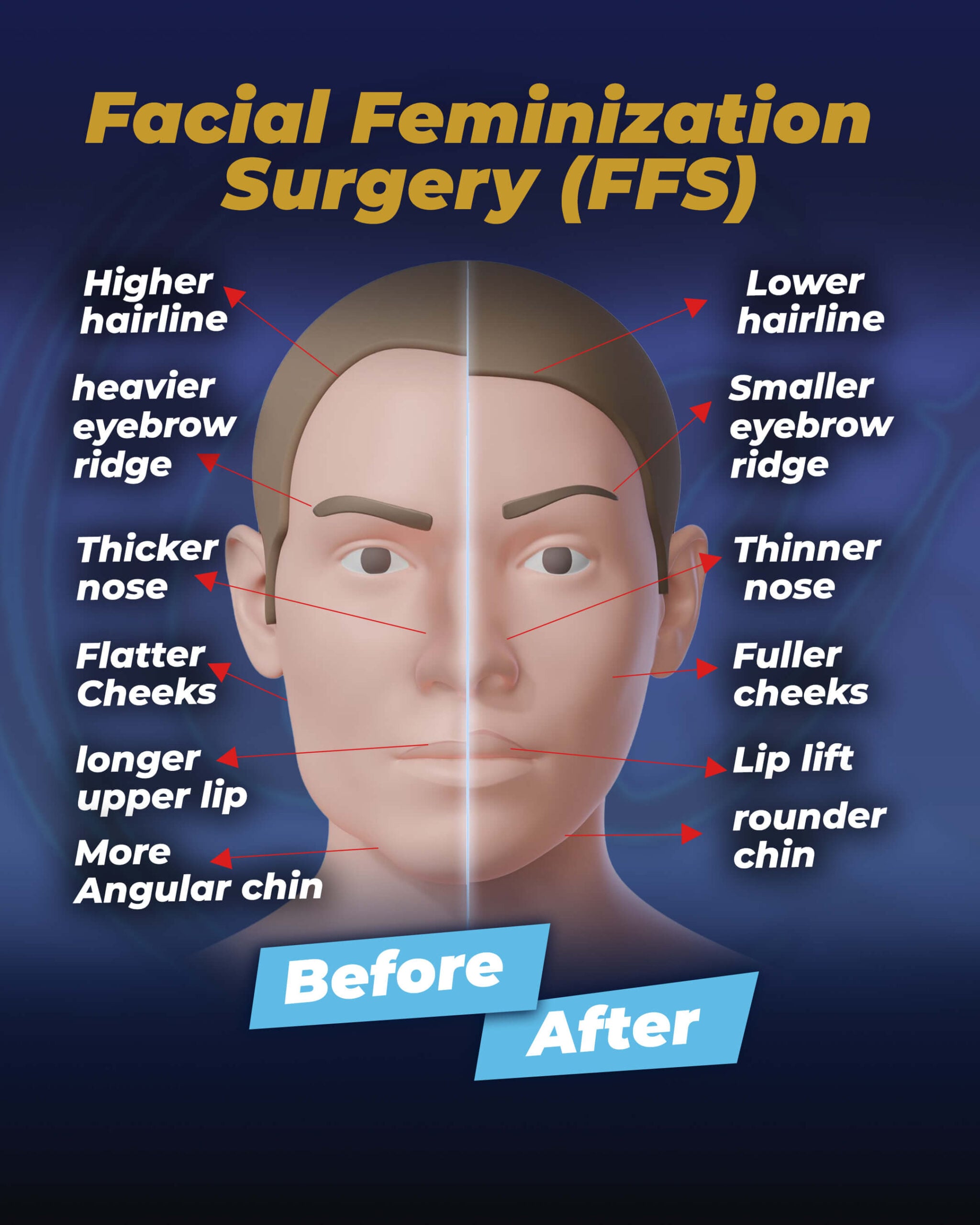 Facial Feminization Before and After | Estherian Clinic