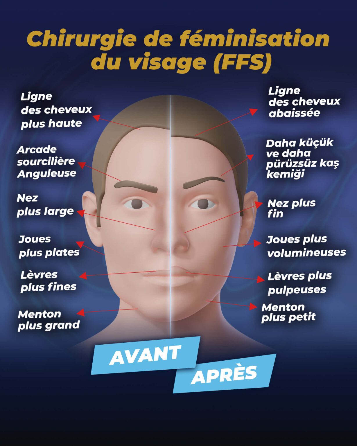 Féminisation Faciale Avant et Après | Estherian Clinic