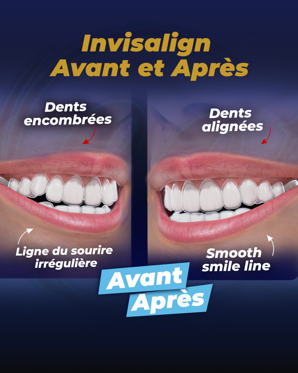 Invisalign Avant et Après | Estherian Clinic
