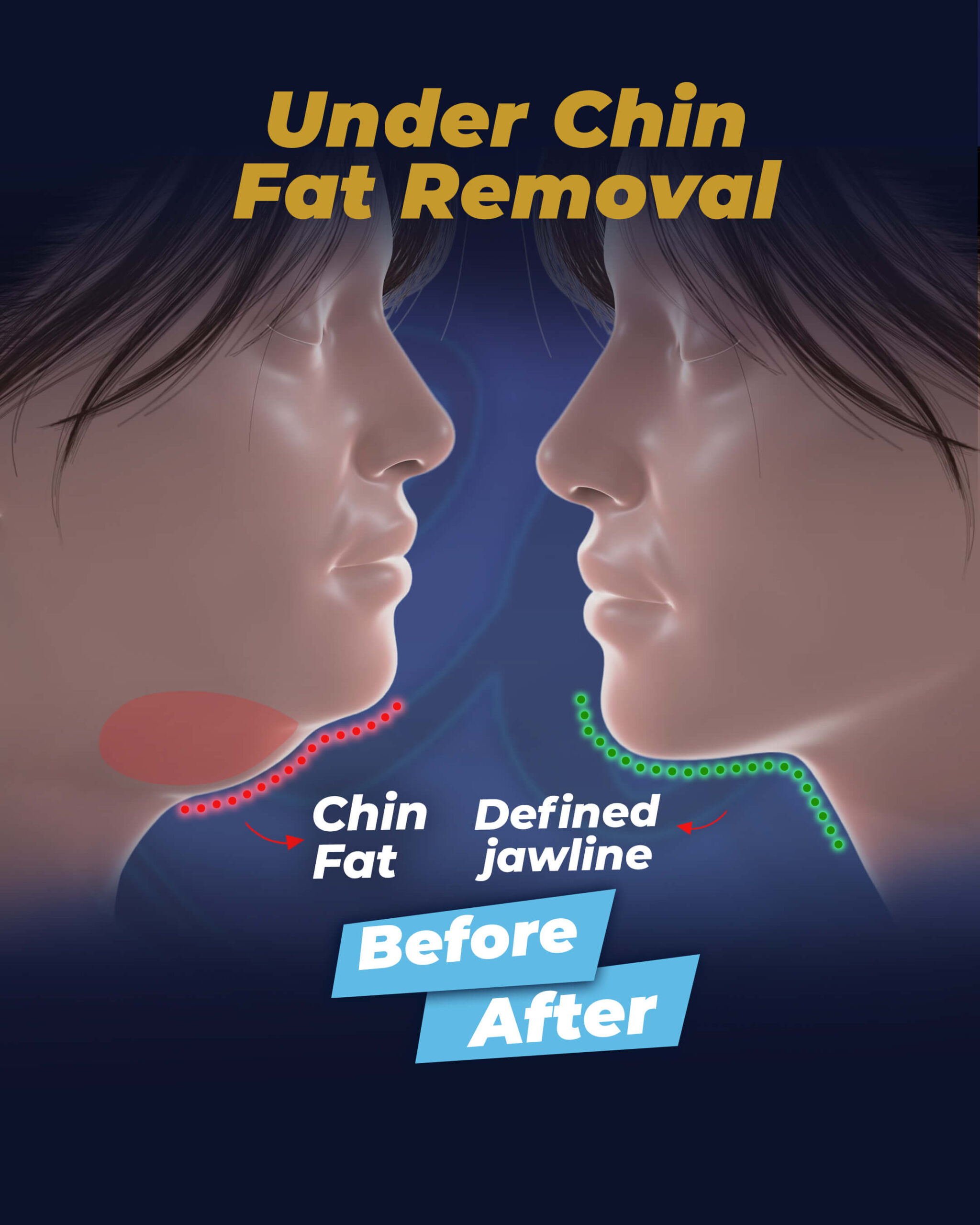 Under Chin Fat Removal: Explore the Techniques | Estherian Clinic
