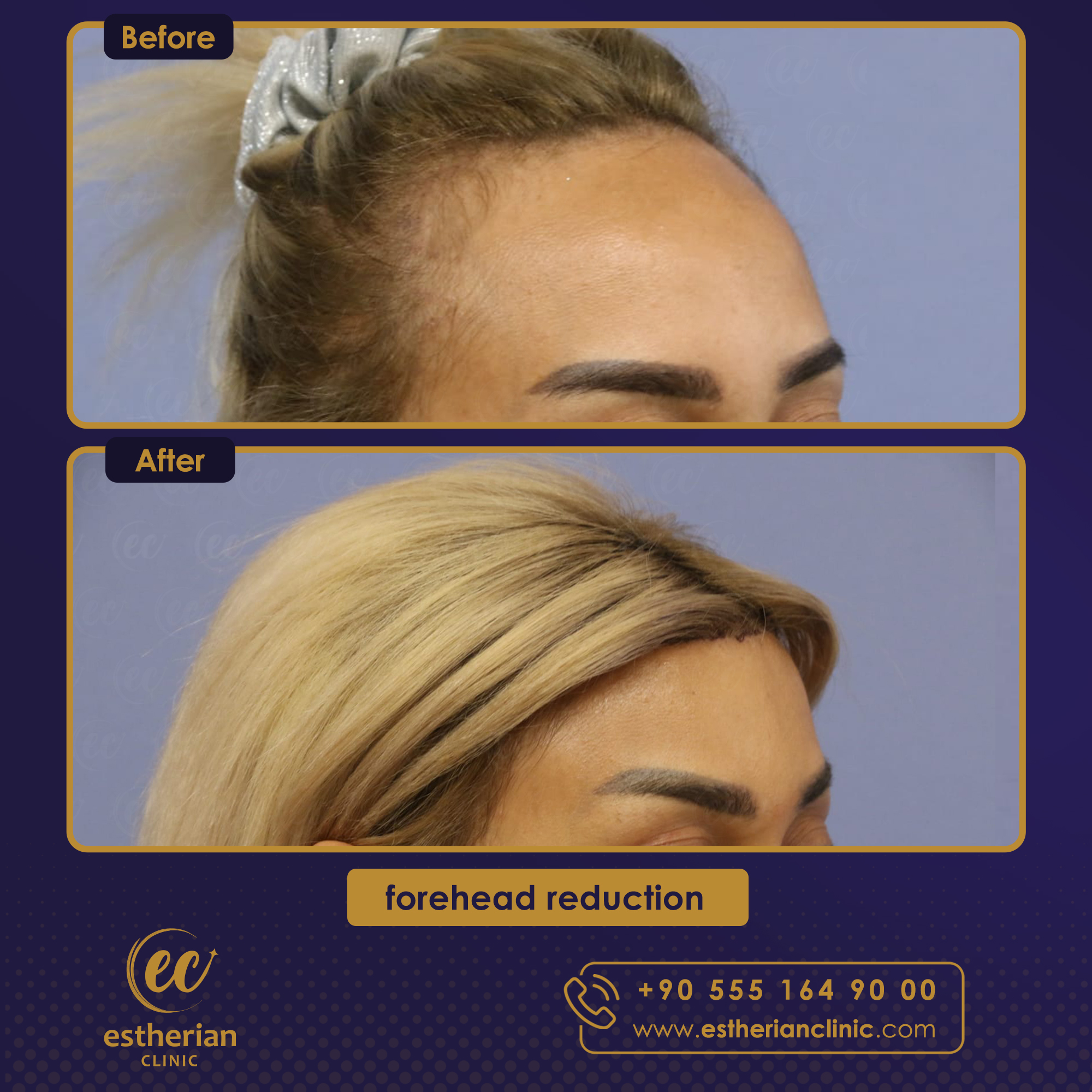 Hairline Lowering In Turkey - Estherian Clinic