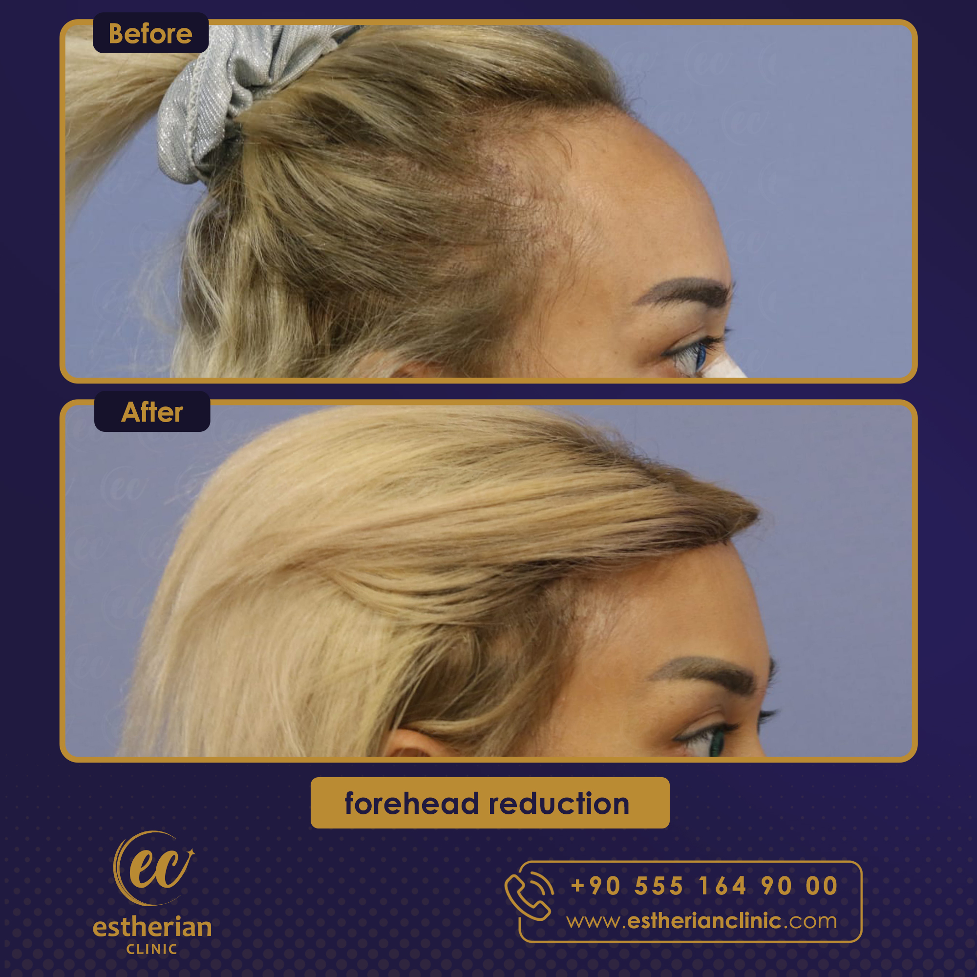 Hairline Lowering In Turkey - Estherian Clinic