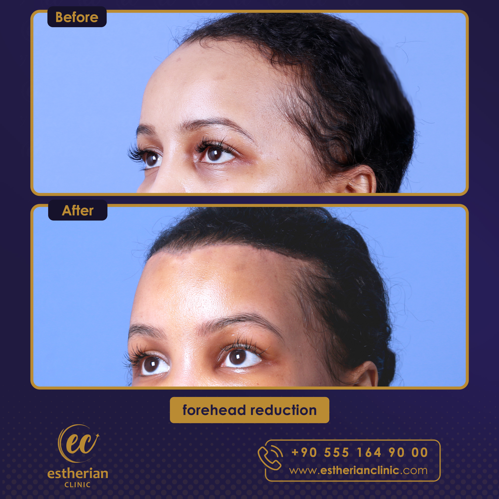 Hairline Lowering In Turkey - Estherian Clinic