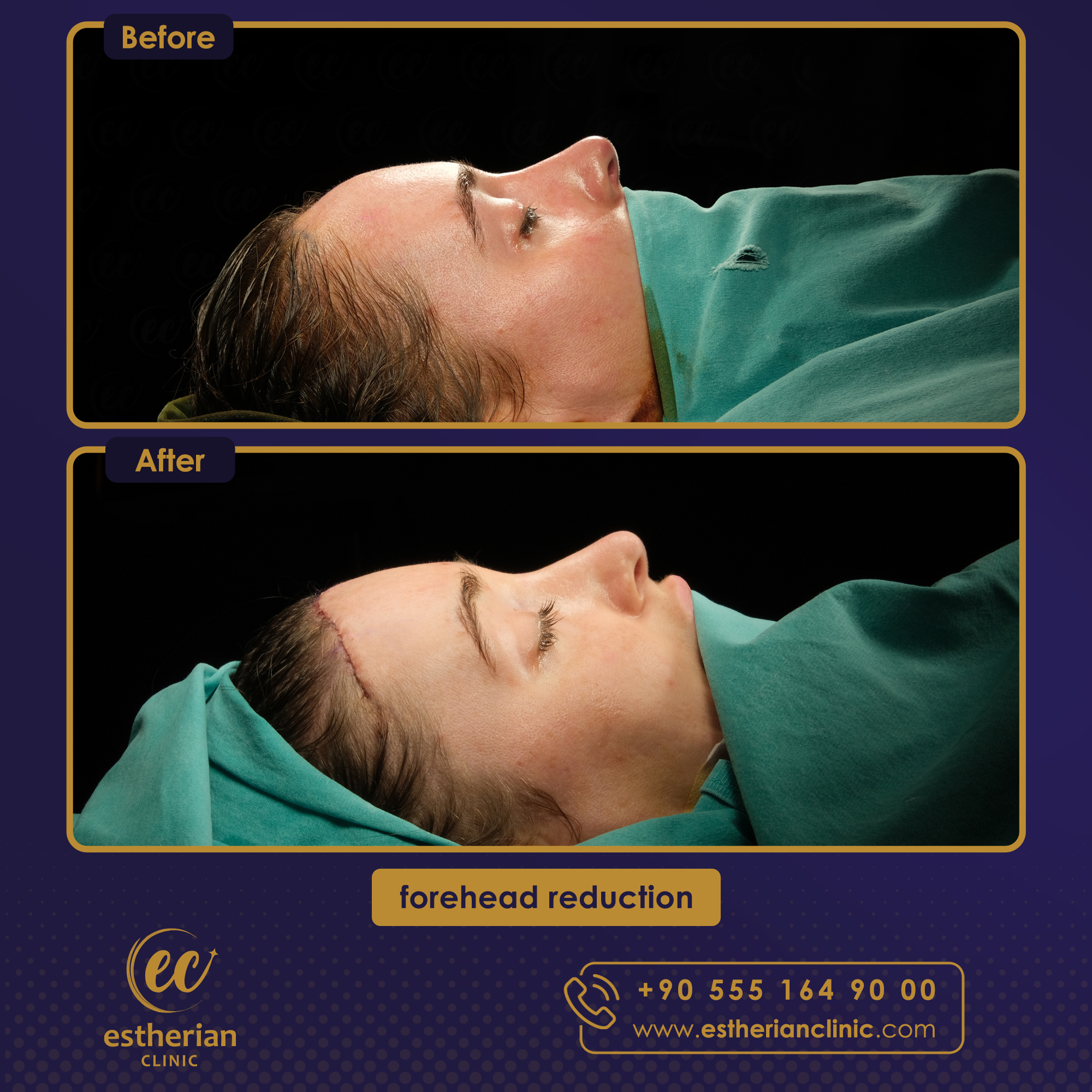 Hairline Lowering In Turkey - Estherian Clinic