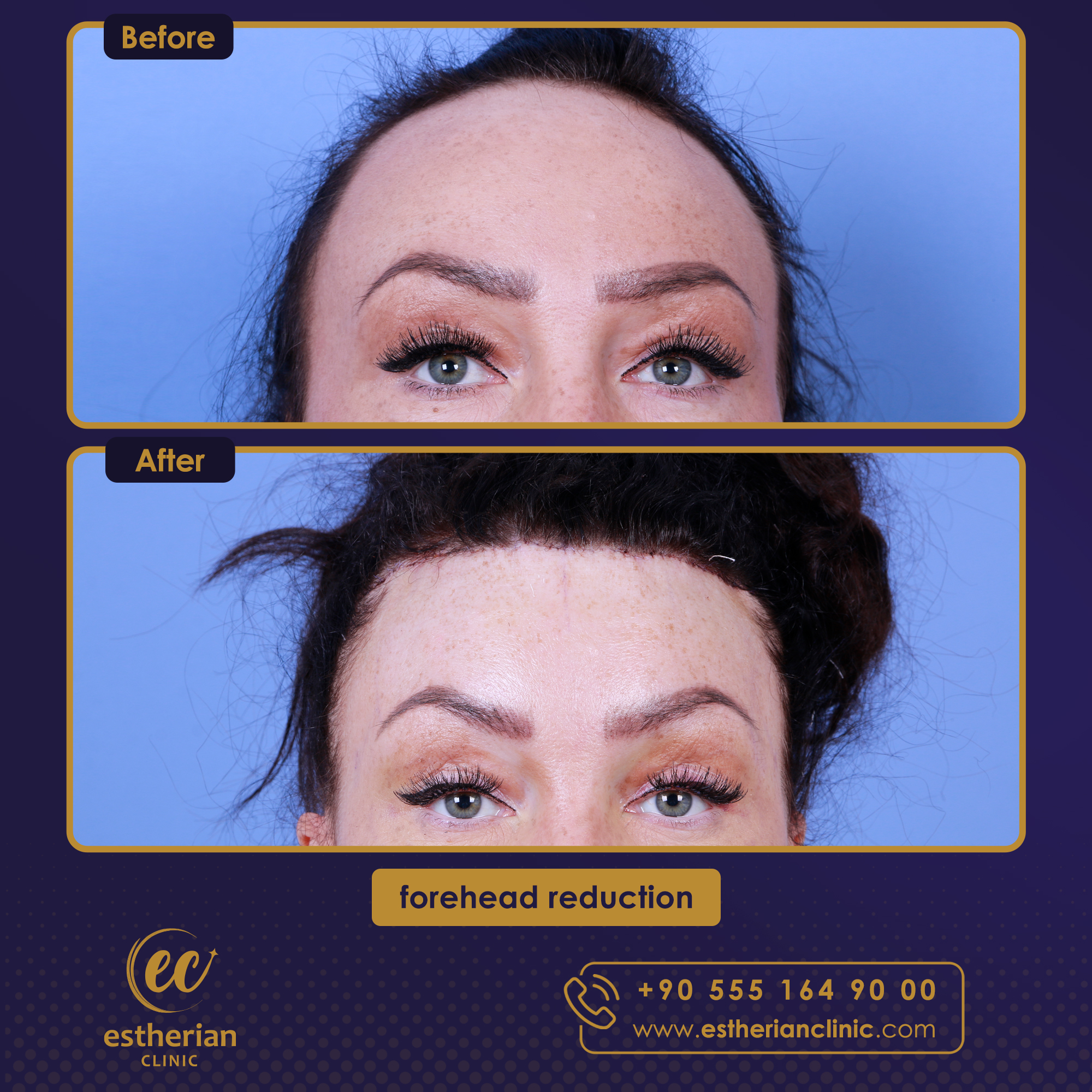 Hairline Lowering In Turkey - Estherian Clinic