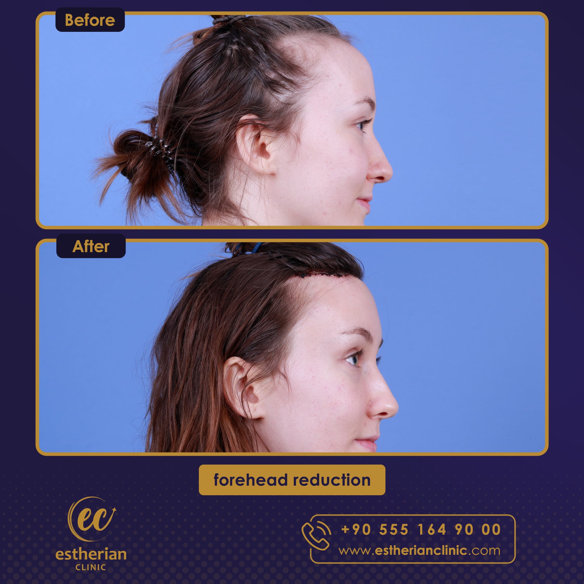 Hairline Lowering In Turkey - Estherian Clinic