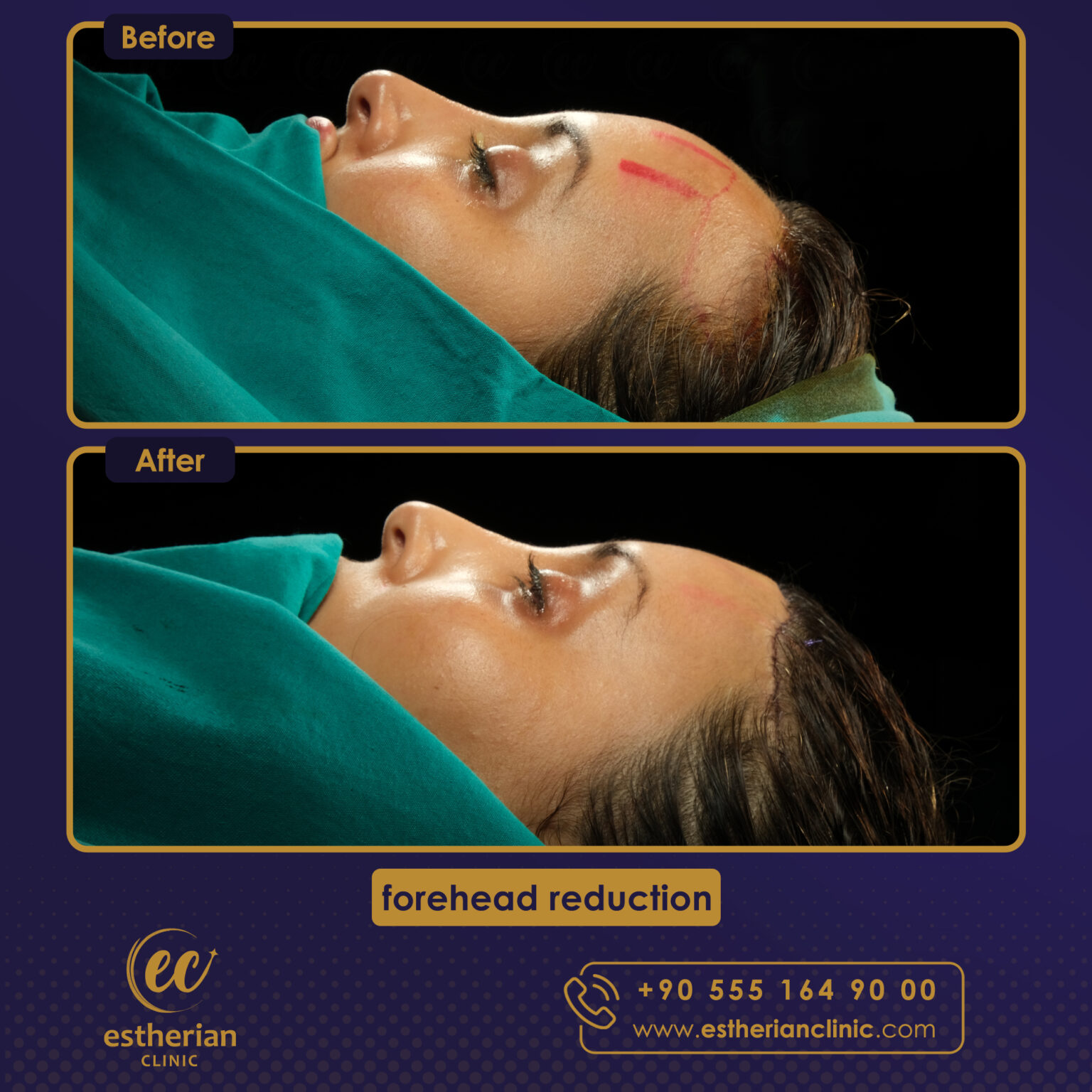 Hairline Lowering In Turkey - Estherian Clinic