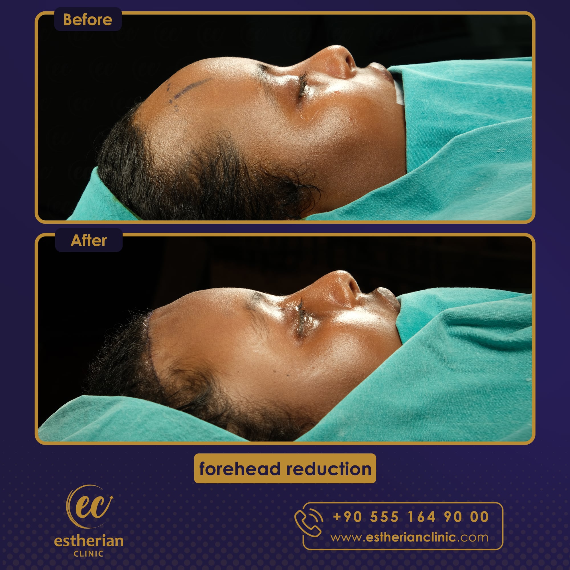 Hairline Lowering & Forehead Reduction in Turkey | Estherian Clinic