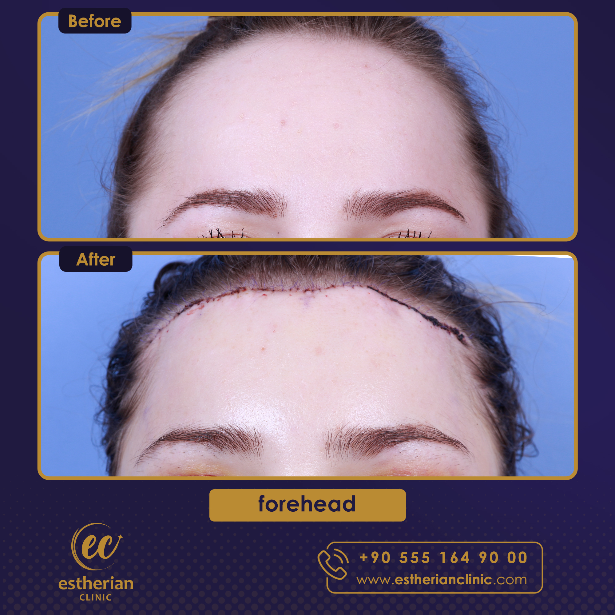 Hairline Lowering & Forehead Reduction in Turkey | Estherian Clinic