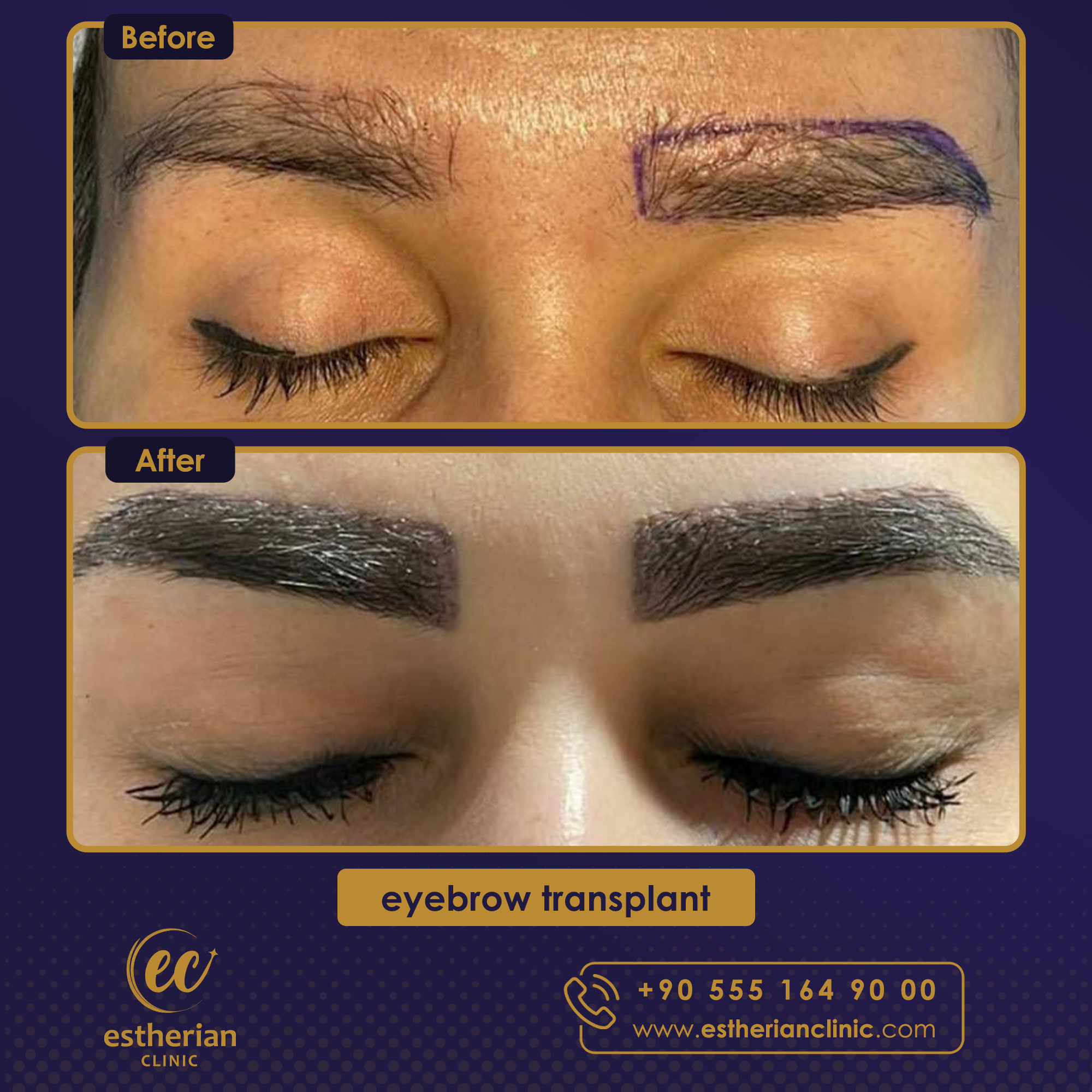 Eyebrow Transplant In Turkey | Estherian Clinic