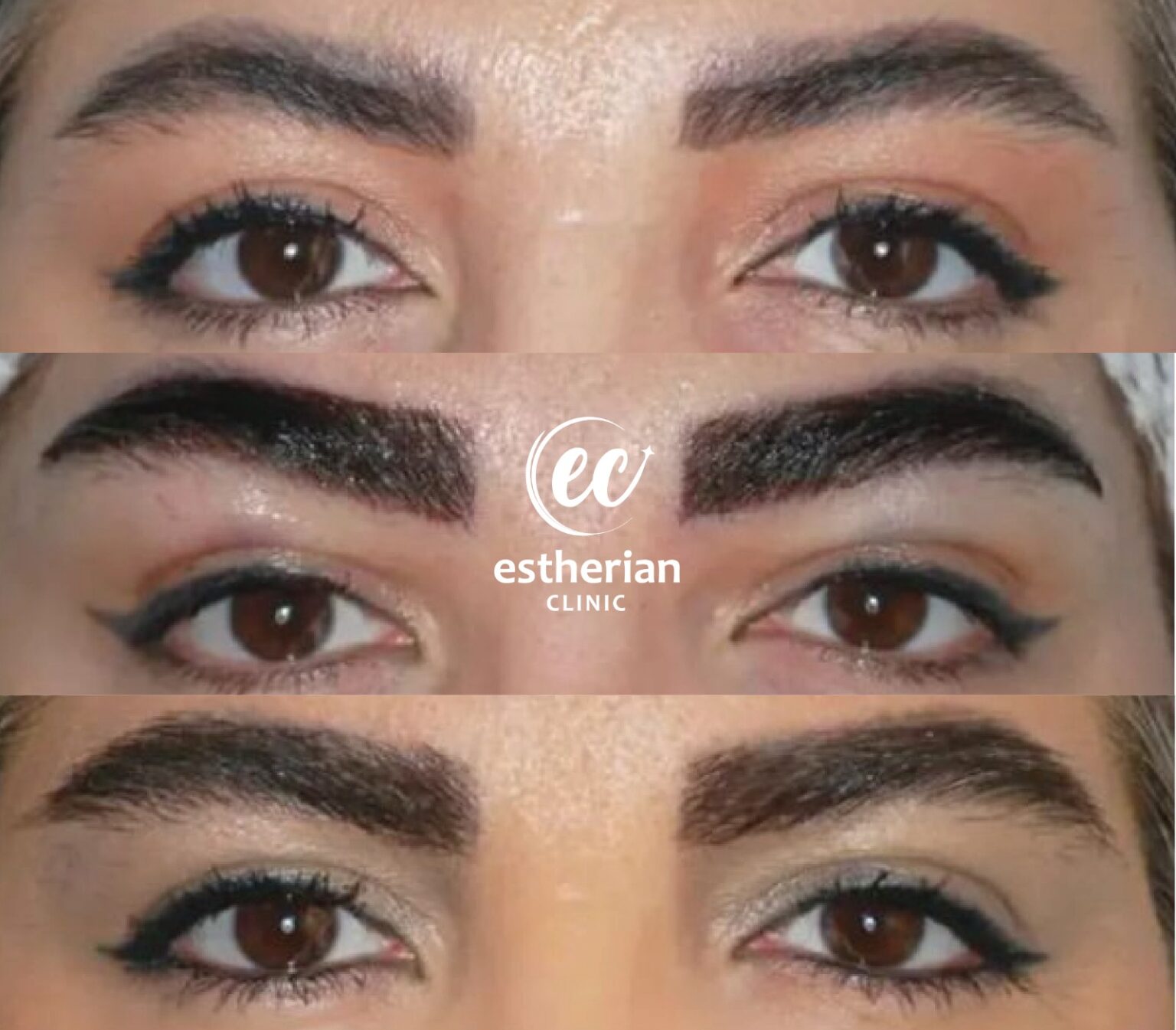 Eyebrow Transplant In Turkey | Estherian Clinic