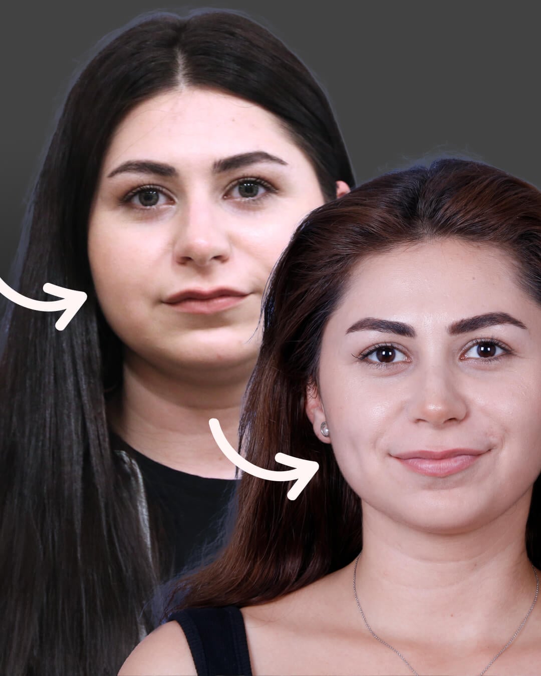 Bichectomy (Buccal Fat Removal) Surgery in Turkey | Estherian Clinic