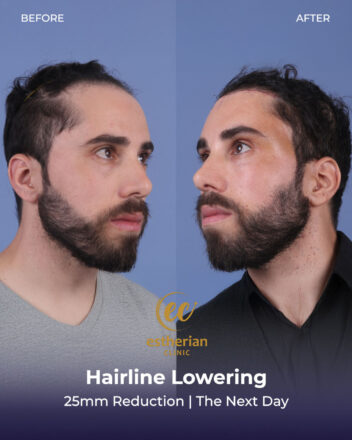 Hairline Lowering & Forehead Reduction in Turkey | Estherian Clinic