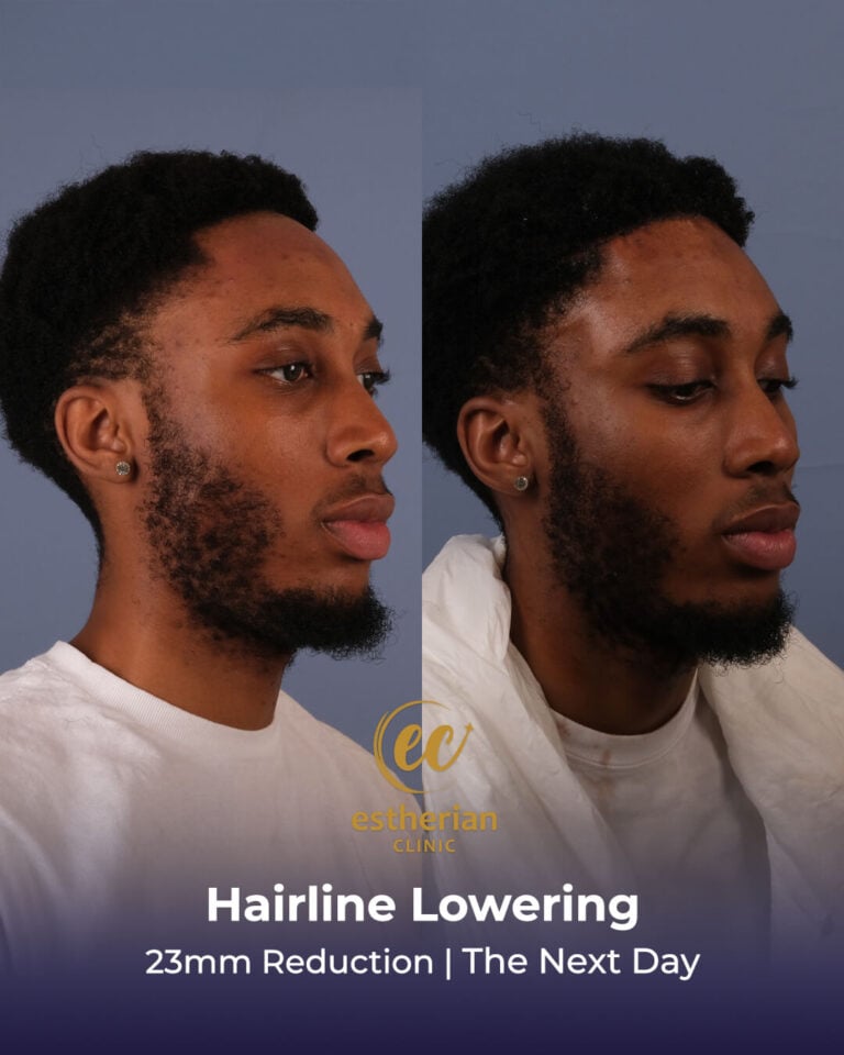 Hairline Lowering & Forehead Reduction in Turkey | Estherian Clinic