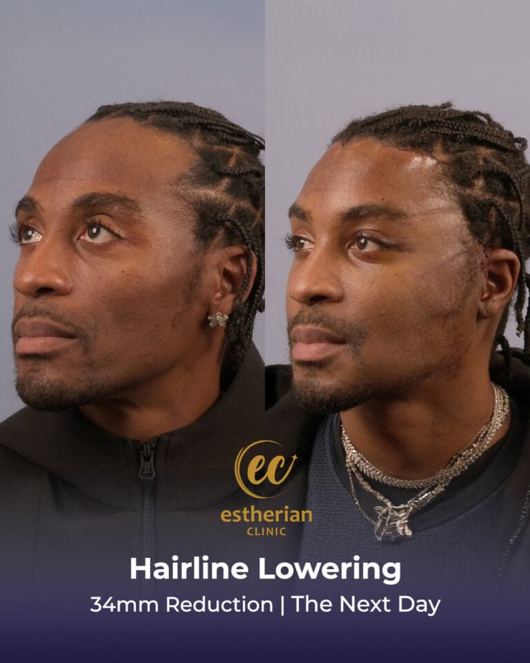 Hairline Lowering & Forehead Reduction in Turkey | Estherian Clinic