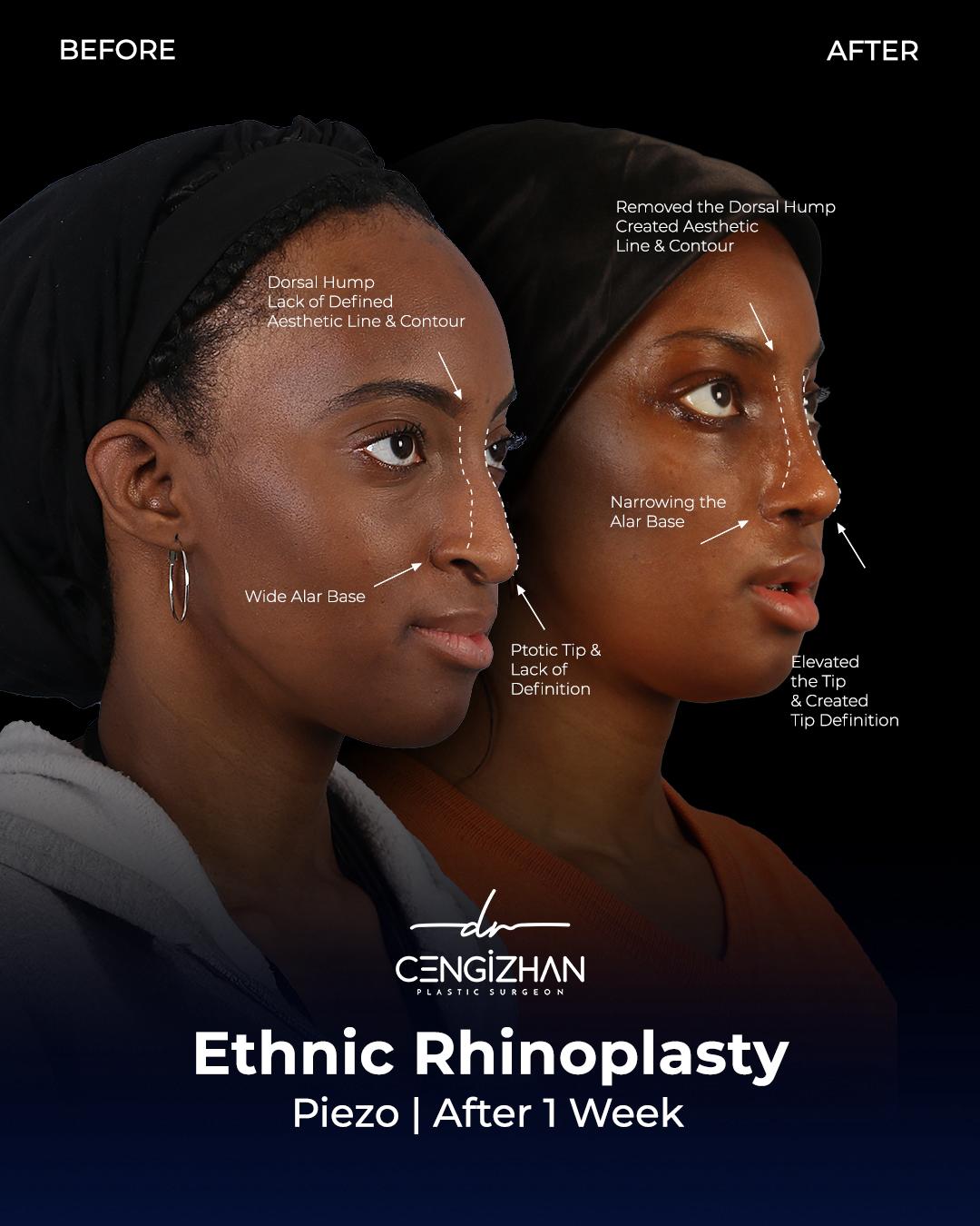 Ethnic Rhinoplasty | Estherian Clinic